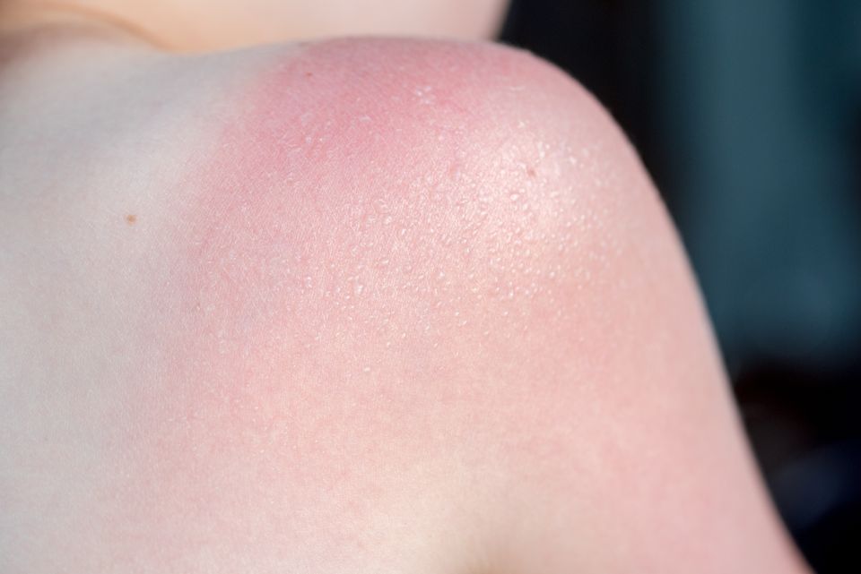Solbrent hud skal ikke tildekkes med sminke | Volvat